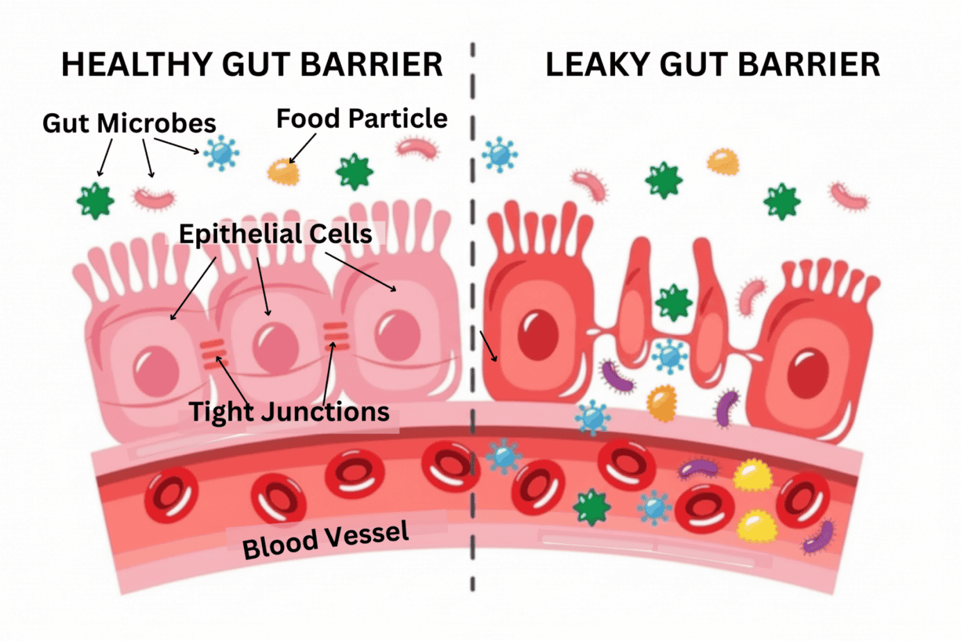 Intestinal Permeability: What Leaky Gut Really Is (and Isn’t) - Terri ...